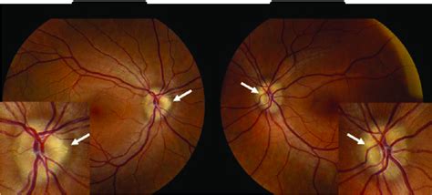 Bilateral Optic Nerve Head Drusen Lumpy Bumpy Appearance Of Both