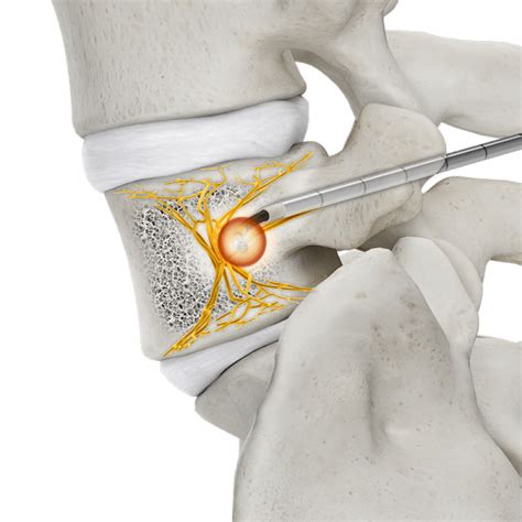 Basivertebral Nerve Ablation Vertrae Neurosurgeon And Spinal Doctor