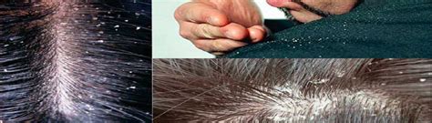 Increíble Mira como Quitar la Caspa Definitivamente y de manera Natural