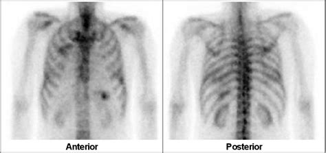 Figure 2 From Diffuse Pulmonary Ossification Developing In Patients With End Stage Renal Disease