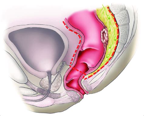Extent Of Total Mesorectal Excision Download Scientific Diagram