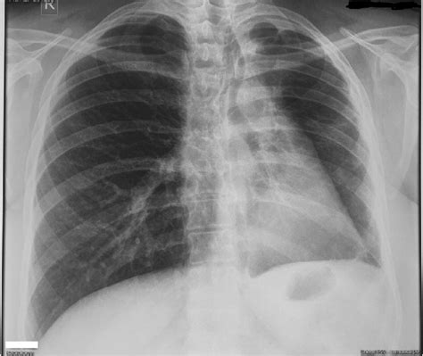 X Raychest Volume Loss Of The Left Lung With Mediastinal Shift Download Scientific Diagram