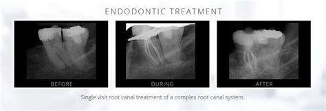 Endodontics Before And After Winston Churchill Dental