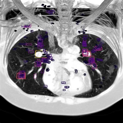 A Lung Nodule Annotation In A Ct Image Of The Lidc Idri Collection