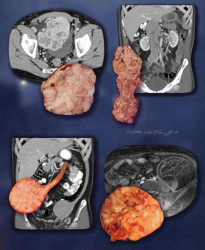Primary Retroperitoneal Sarcomas Radiographics