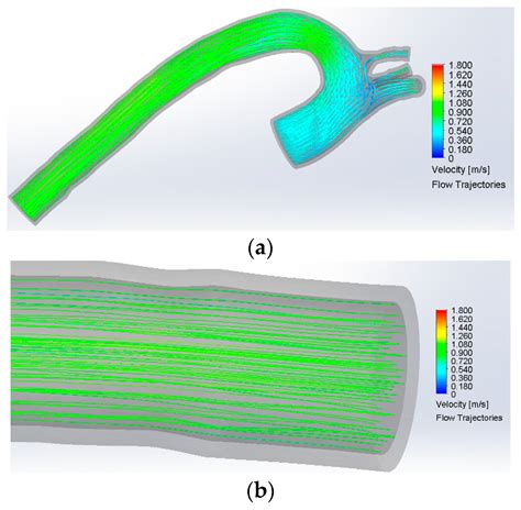 A Smart Stent For Monitoring Eventual Restenosis Computational Fluid Dynamic And Finite Element