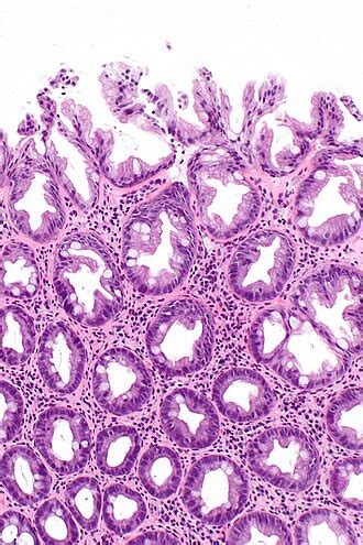 Hyperplastic Polyp Pathology Outlines