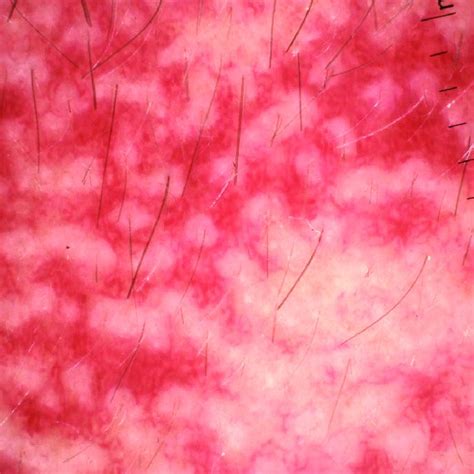 Cutis Rhomboidalis Nuchae With Erythrosis Interfollicularis Collis In Download Scientific