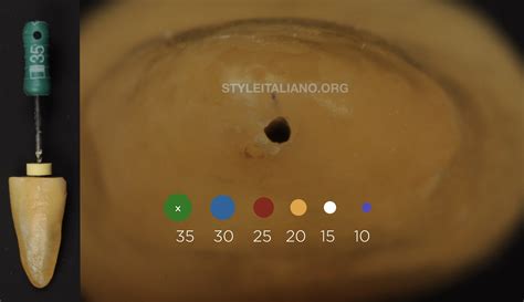 Last Check Of The Working Length Style Italiano Endodontics