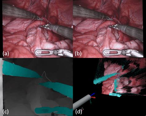 Left A And Right B Stereo Rectified Endoscopic Frame Form The RIS