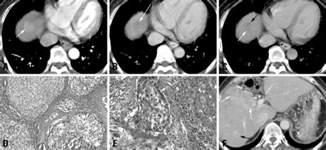 A 56 Year Old Female With Early Recurrent Hcc After Segmentectomy The
