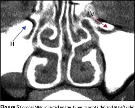 Figure 5 From Anatomic Patterns Of Maxillary Sinus Drainage Semantic