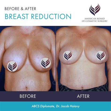 Breast Reduction Before And After