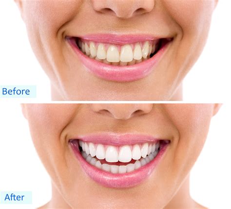 Edmonton Teeth Whitening Illuminada Dental Enjoy A Healthy Smile
