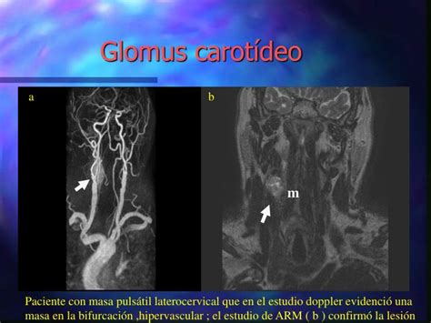 Ppt Rm En Los Paragangliomas De La Región Cervicofacial Powerpoint