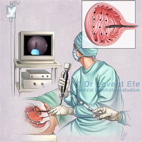 Intravesical Botox Dr Efes Medical Art Store Medical Illustrations