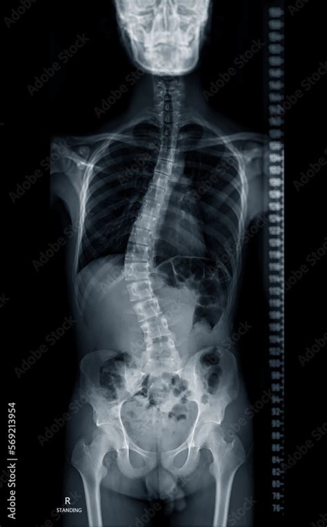 X Ray Image Of Whole Spine For Diagnosis Scoliosis Of Spine Stock