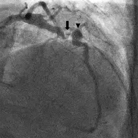 Left Heart Catherization Identifying The Left Anterior Descending