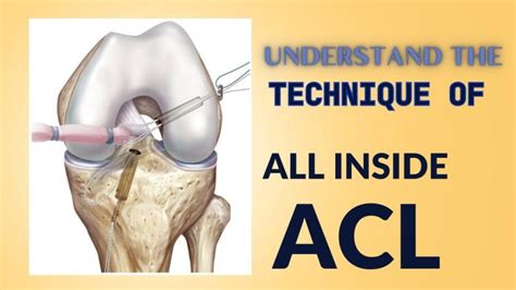 All Inside Acl Reconstruction How It Is Done Dr Sharath K R