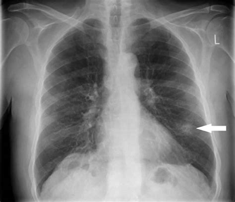 Solitary Pulmonary Nodule Definition Causes Symptoms Diagnosis And Treatment