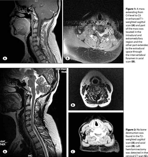 Figure 2 From Cervical Primary Ewings Sarcoma In Intradural And Extramedullary Location And