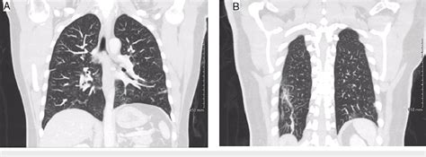 Ct Scan During The Second Visit Indicates Scattered Areas Of