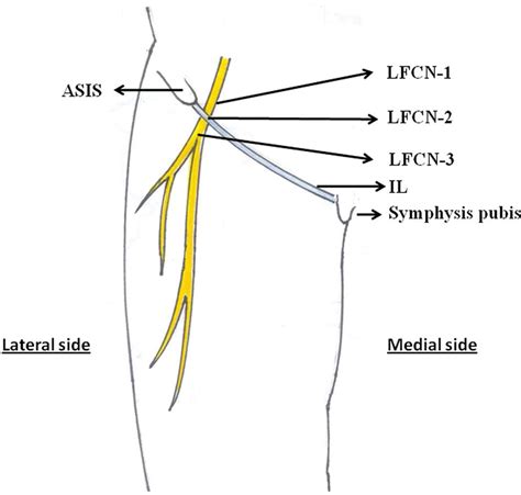 Pdf] Nerve Block Of Lateral Femoral Cutaneous Nerve Of The 57 Off
