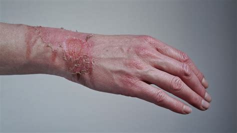 Do Electrical Burns Leave Scars