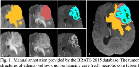 Figure 1 From Glioma Segmentation With A Unified Algorithm In