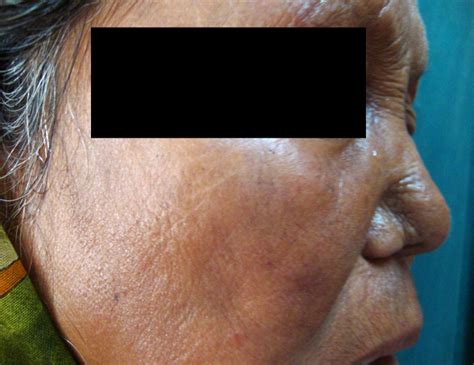 Patient 2 A Patient With Lepromatous Leprosy Ll Showing Saddle Nose