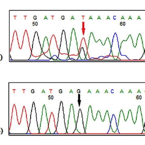 A Missense Mutation C 2645g C In Exon 23 Dnmt3a With Substitution Of