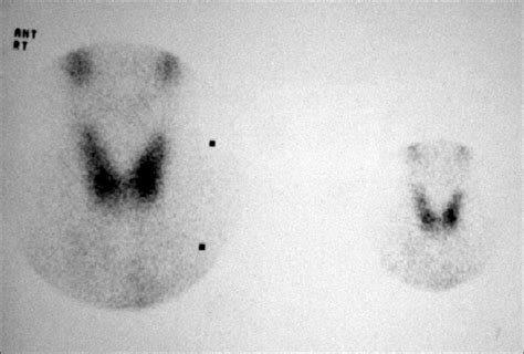 The Technetium 99m Thyroid Scan The Thyroid Gland Is Slightly Enlarged