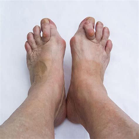 Toe Deformities Active Alignment Orthotics Bracing And Foot Care