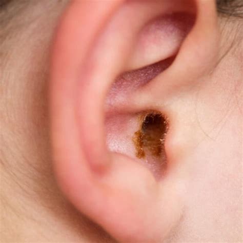 All About Earwax Decibel Hearing Services Blog