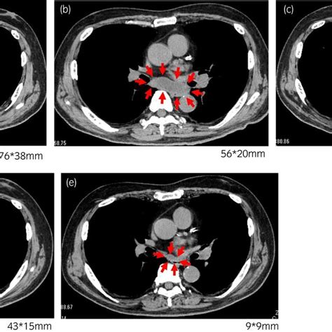 Computed Tomography Scan Images Demonstrate A Decrease In Size Of