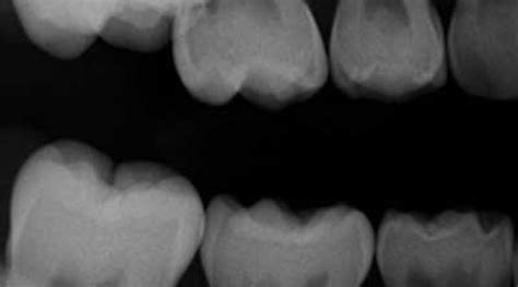 Orthodontic Options For The Ectopic Eruption Of A Maxillary First Molar