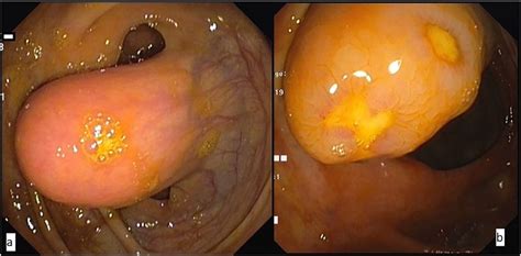 E Colonoscopy Image Showing A Large Pedunculated Cecal Polyp And B Download Scientific