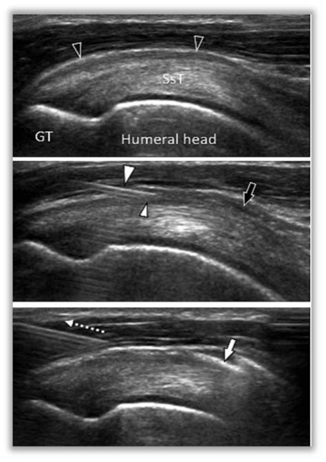 Ultrasound Guided Injections A Review Of The Evidence — Dr Rajiv Verma
