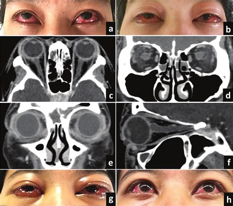 A Bilateral Moderate Diffuse Conjunctival Injection Observed 6 Days