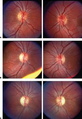 Hereditary Optic Neuropathies Ento Key