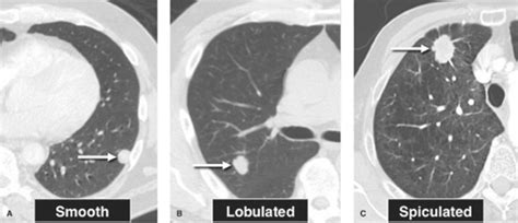 Pulmonary Neoplasms Radiology Key