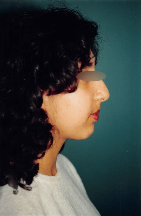 CHIN IMPLANTS Dr Lorne Brown