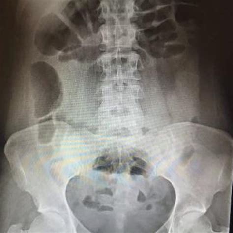 Pdf Post Polypectomy Syndrome Presenting With “micro Perforation” And Pneumoperitoneum