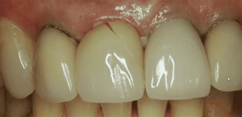 Trauma Care To Repair Cracked Front Tooth Case Study By Dr Guy