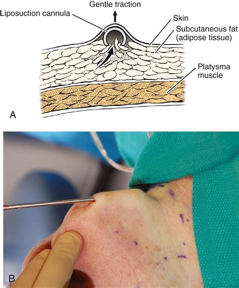 Rhytidectomy And Facial Liposuction Clinical Tree