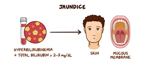 Video Approach To Jaundice Conjugated Hyperbilirubinemia Clinical Sciences