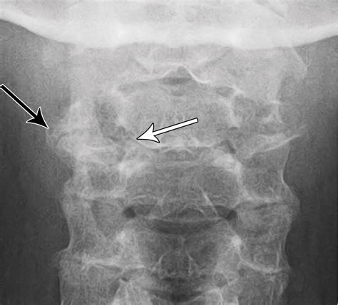 The Art Of Interpreting Cervical Spine Radiographsradiographics