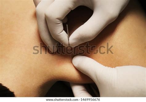 Trigger Point Dry Needling Images Stock Photos Vectors Shutterstock