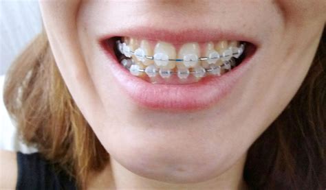 Proceso De Los Brackets Mes A Mes Actualizado Noviembre 2025
