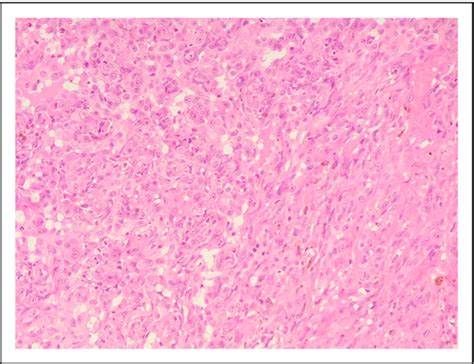 Figure 2 From Angiosarcoma And Vascular Surgery A Case Report And